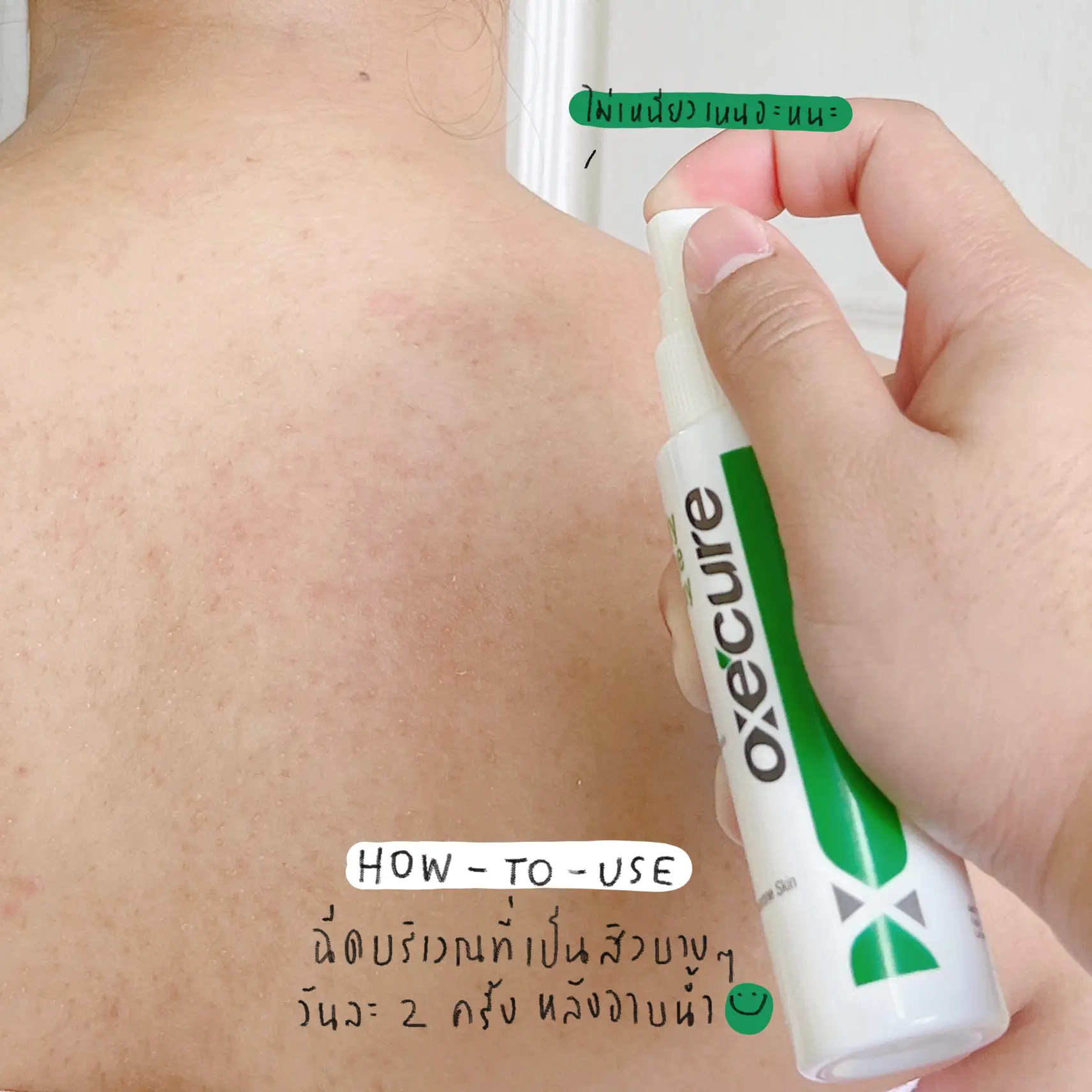 Oxecure Body Acne Spray💚สเปรย์ฉีดตัวลดสิวสุดฮอต | แกลเลอรีที่โพสต์โดย ...