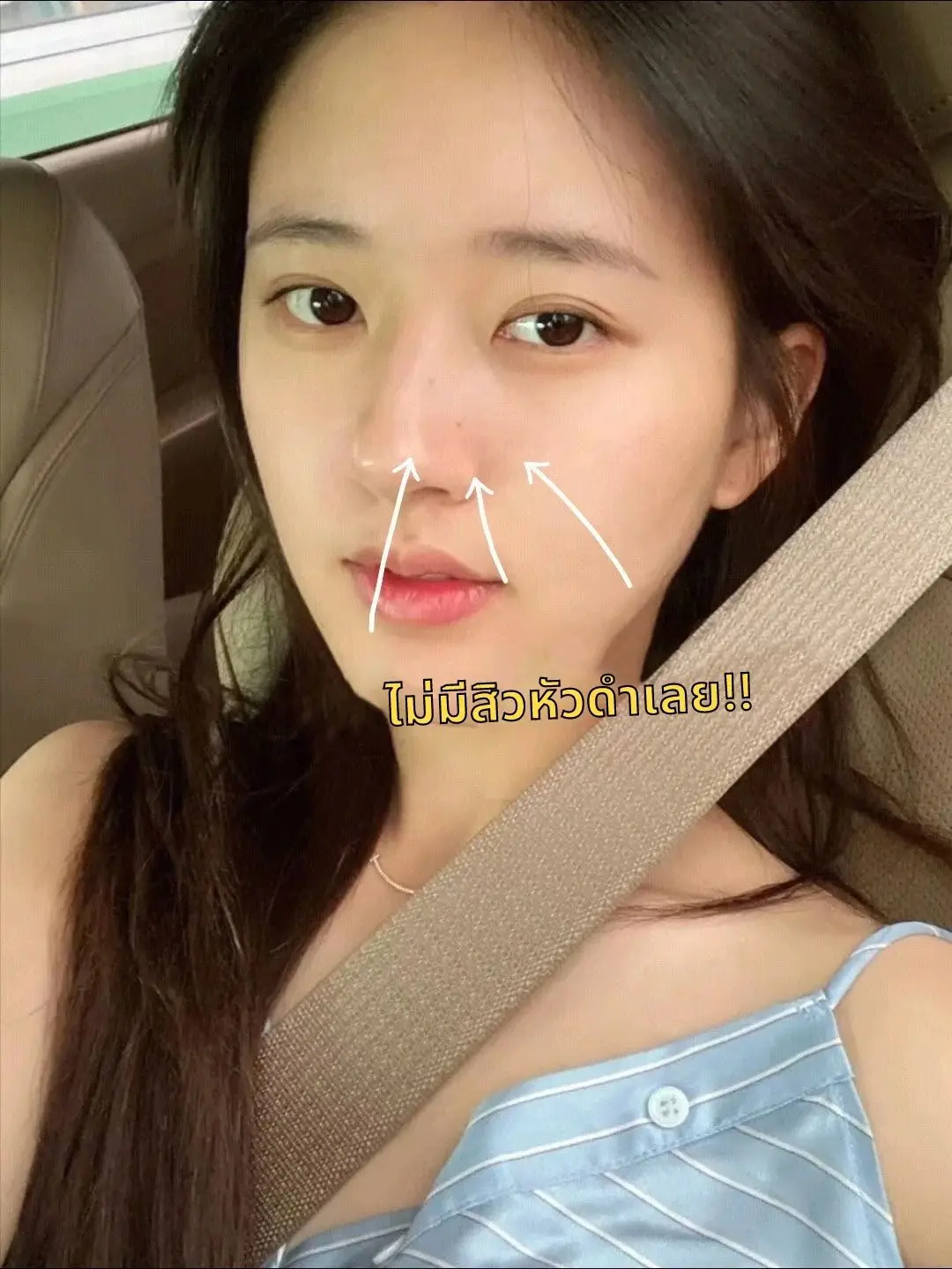 Get Rid Of The Blackheads Gallery Posted By Katty Lemon8 Get Rid Of The Blackheads Gallery Posted By Katty Lemon8