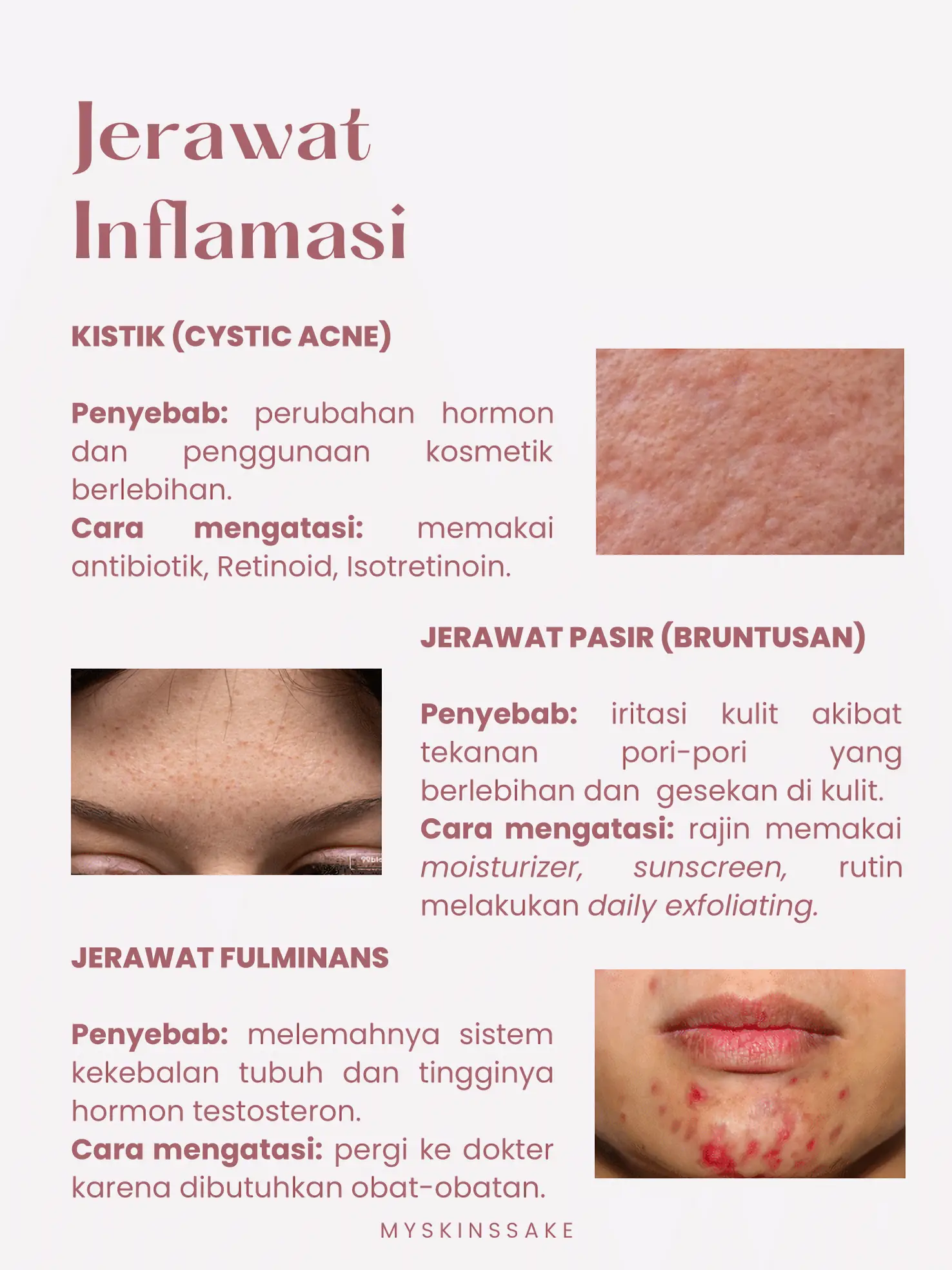 Jenis-Jenis Jerawat 🔍🤔 | Galeri diposting oleh Gita 💐 | Lemon8