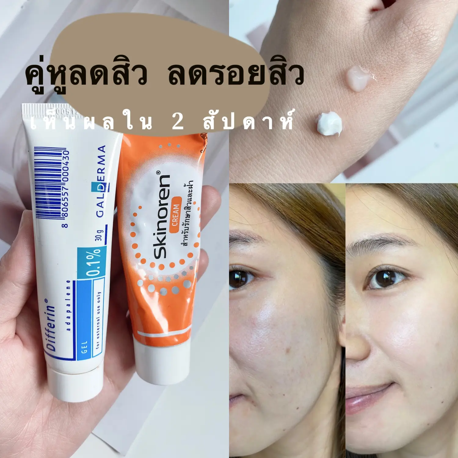 Skinoren ครีมลดรอยสิวฝ้าตัวดังจากกลุ่มFB (มีภาพรีวิวจริง) | แกลเลอรีที่ ...