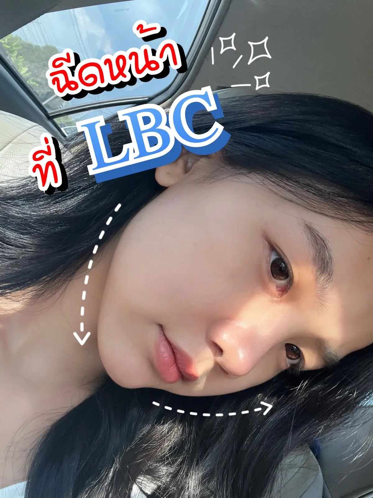 ฉีดหน้าที่ LBC ผลลัพธ์เป็นยังไงบ้าง? | แกลเลอรีที่โพสต์โดย ingy | Lemon8
