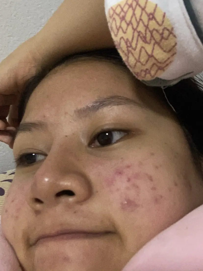 สกินเเคร์บอกลาสิวผด สิวฮอร์โมน | แกลเลอรีที่โพสต์โดย toon_supatta | Lemon8