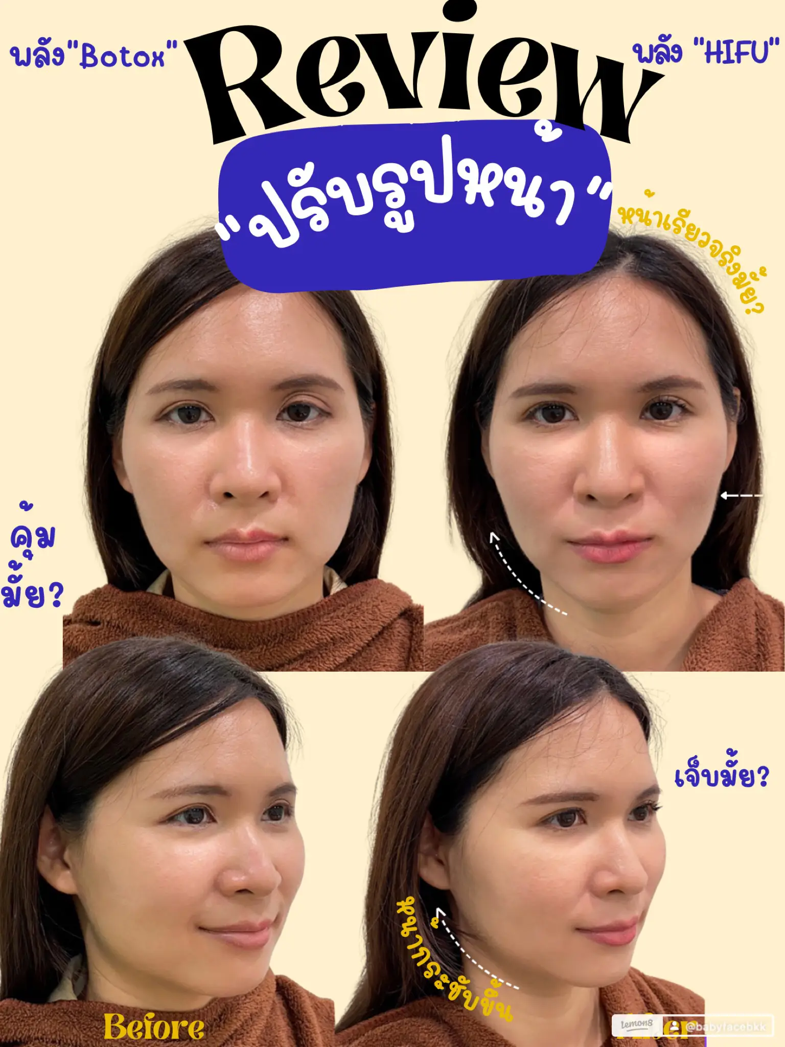 รีวิว ปรับรูปหน้า “พลังไฮฟู่ / botox “ | แกลเลอรีที่โพสต์โดย Babyfacebkk | Lemon8