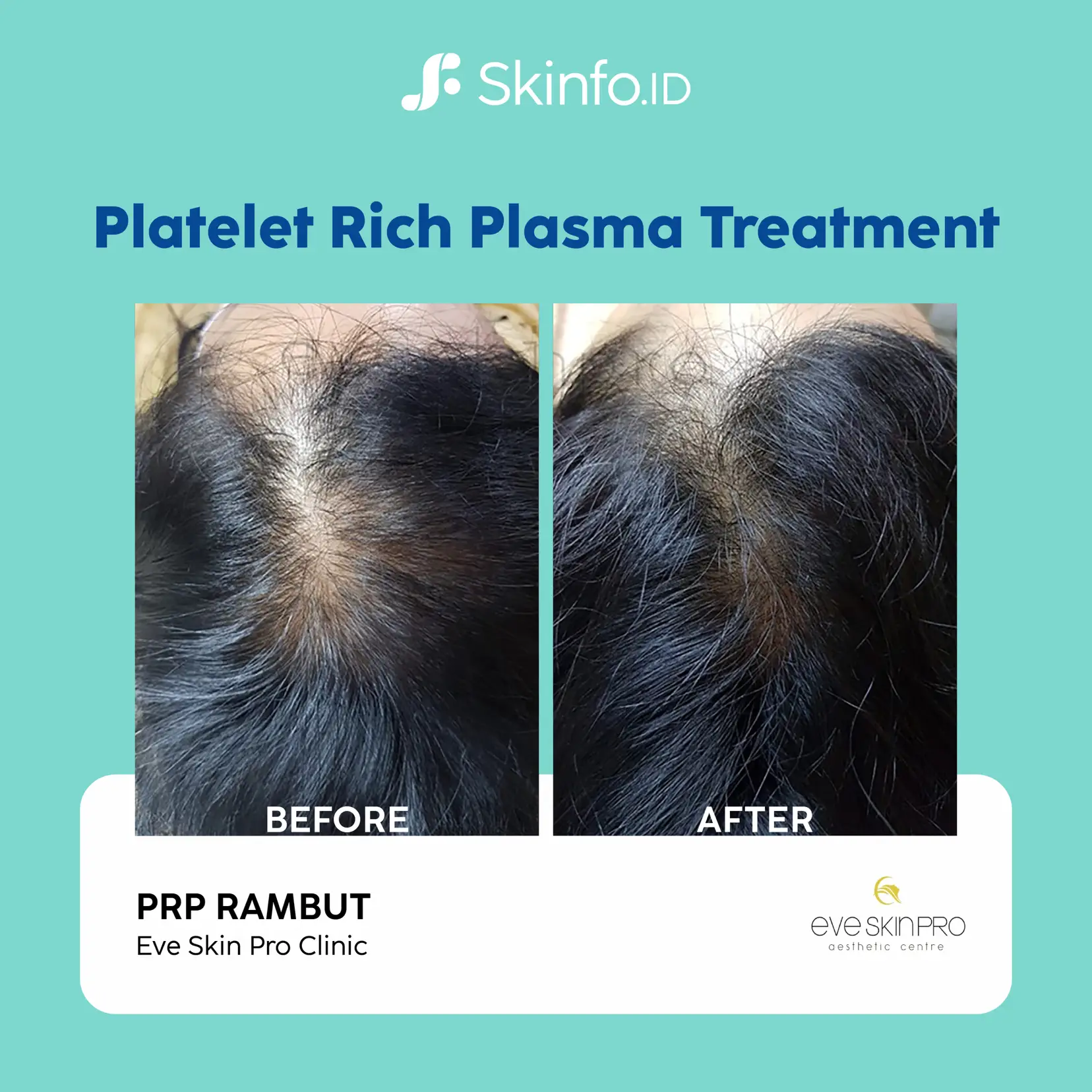 Hasil Nyata!!! Before After PRP Rambut | Galeri diposting oleh Skinfo ...