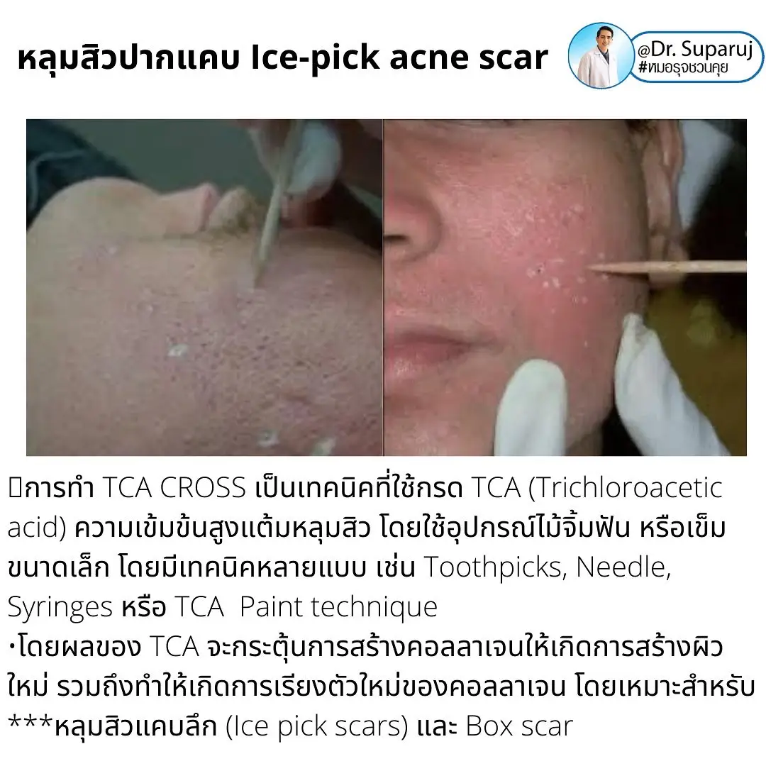 แต้มหลุมสิวด้วย TCA cross | แกลเลอรีที่โพสต์โดย ชิต้าร์ไปเรื่อย | Lemon8