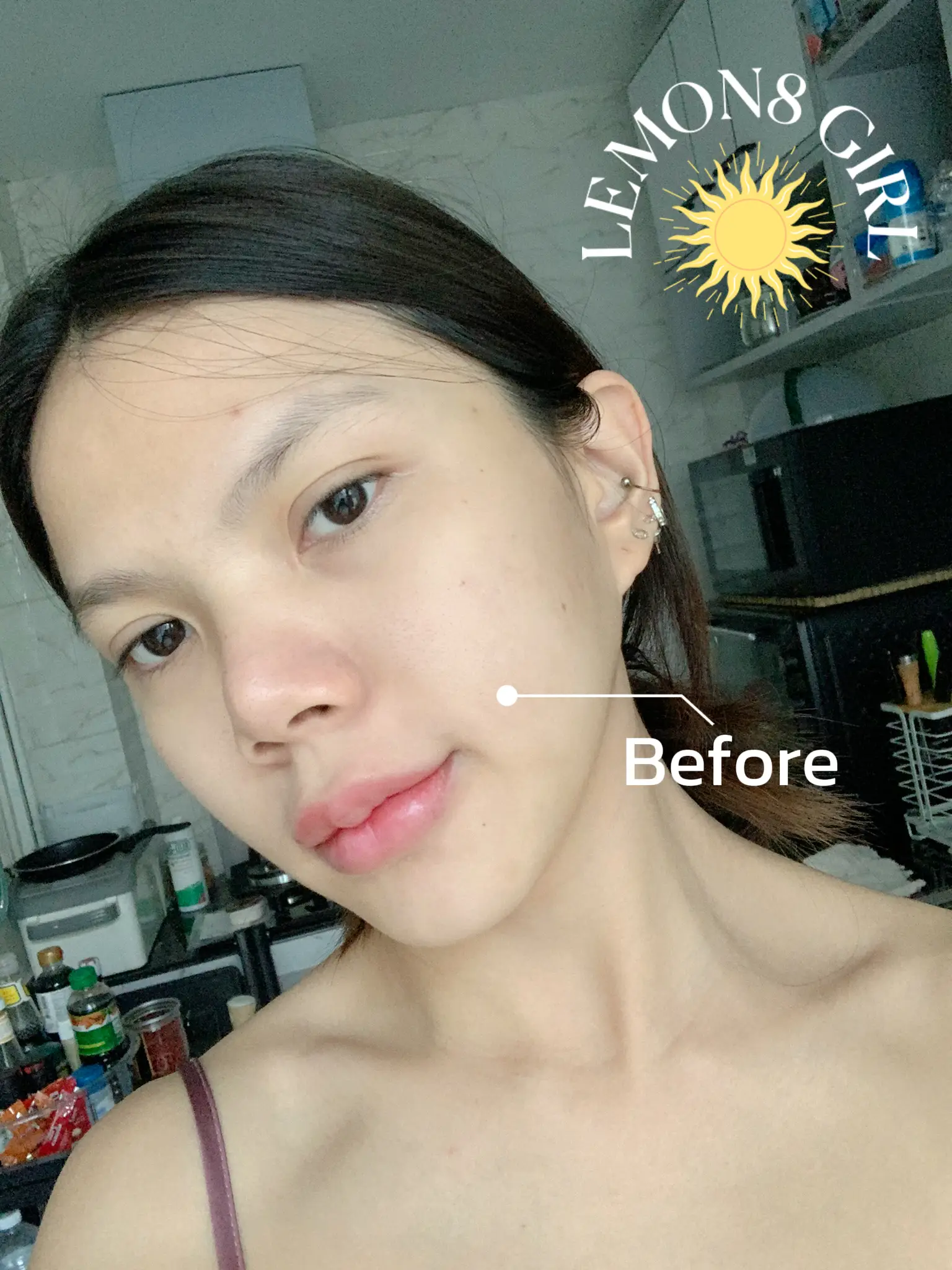 รีวิว Ultramax Hifu - การค้นหาใน Lemon8