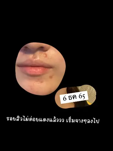 รักษาสิวใน 5 วัน (ฉบับสิวไม่เยอะ) 🌟 | แกลเลอรีที่โพสต์โดย mp | Lemon8