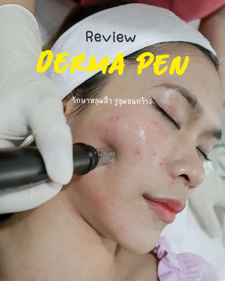 Derma Pen🪄 | แกลเลอรีที่โพสต์โดย Nook Saowaluk | Lemon8