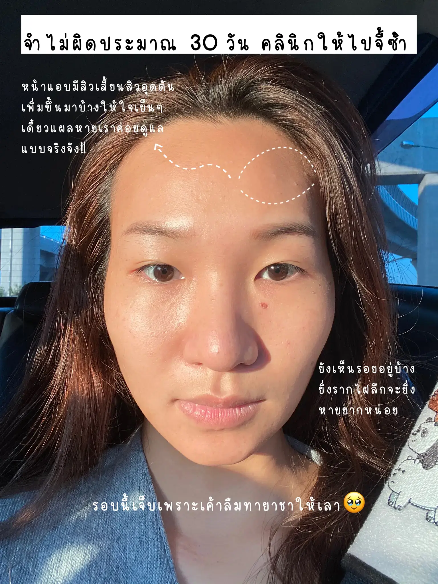 จี้ไฝครั้งแรกในชีวิต 107 จุด รอดหรือร่วง!! | แกลเลอรีที่โพสต์โดย Apis ...