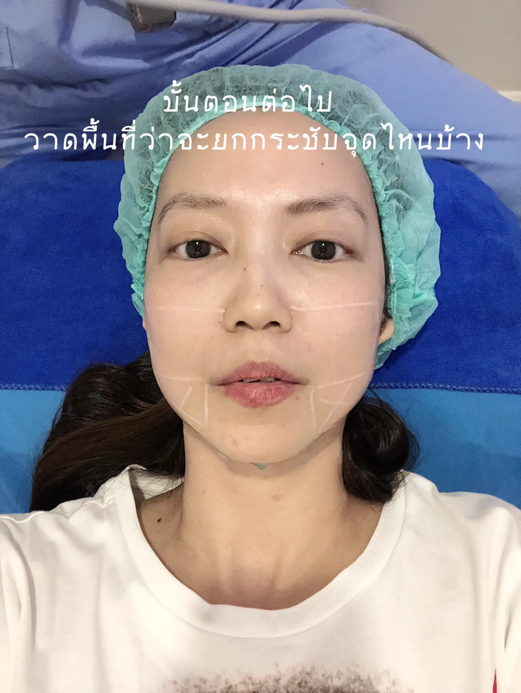 รีวิวลองทำ Hifu ครั้งแรกในชีวิต 😍 (my first time Hifu) | แกลเลอรีที่โพสต์โดย Phye Beautyhaus ...