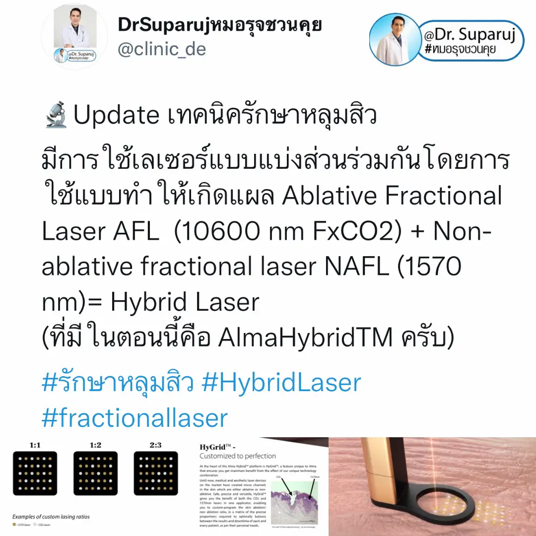 Update Hybrid Laser Acne Pit Treatment Technique | Gallery posted by ...