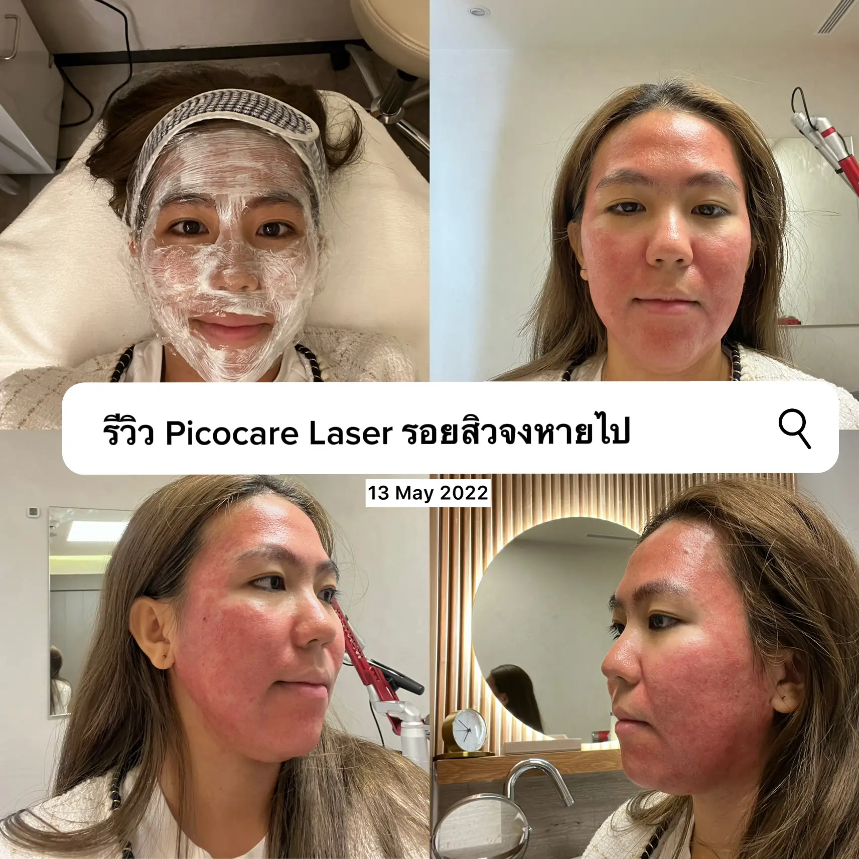 รีวิว Pico Laser+ Meso fat ที่ Dii | แกลเลอรีที่โพสต์โดย Fernnydiaryy ...