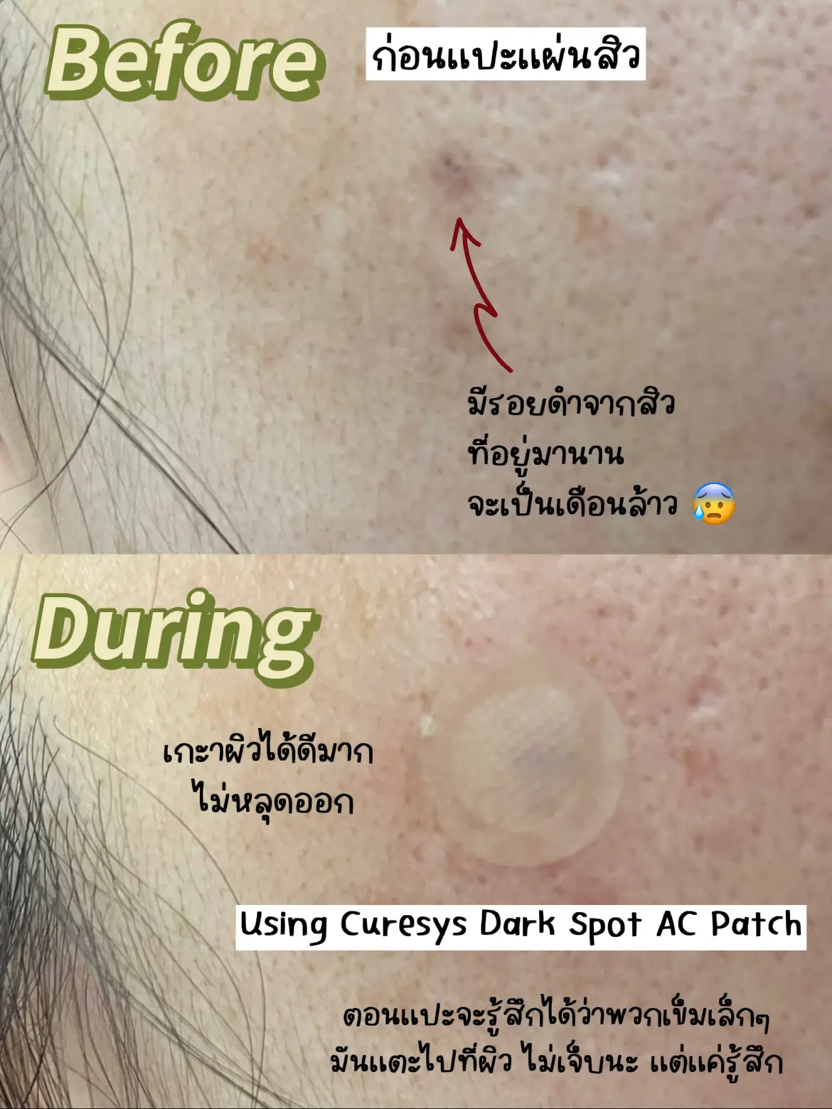รีวิวแผ่นแปะลดรอยสิว Curesys Dark Spot AC Patch | แกลเลอรีที่โพสต์โดย ปลา thelipstickfairy | Lemon8
