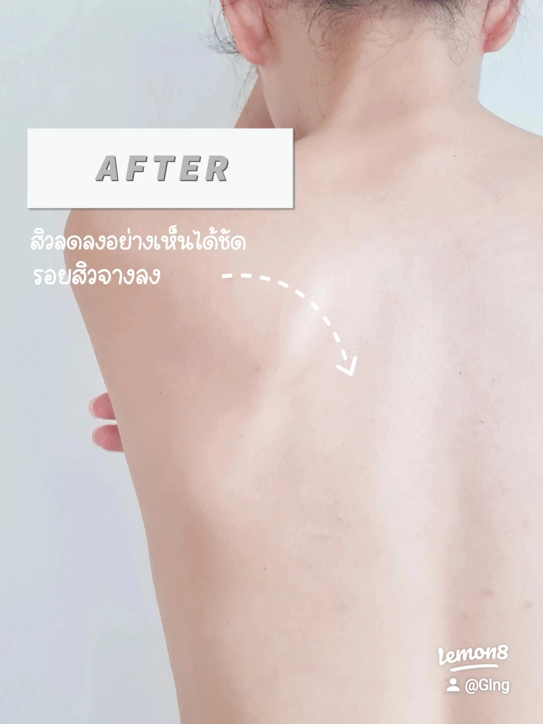 แนะนำไอเท็มเด็ด!! รักษาสิวหลัง ก้นและอก ️ | แกลเลอรีที่โพสต์โดย Gingbabe | Lemon8