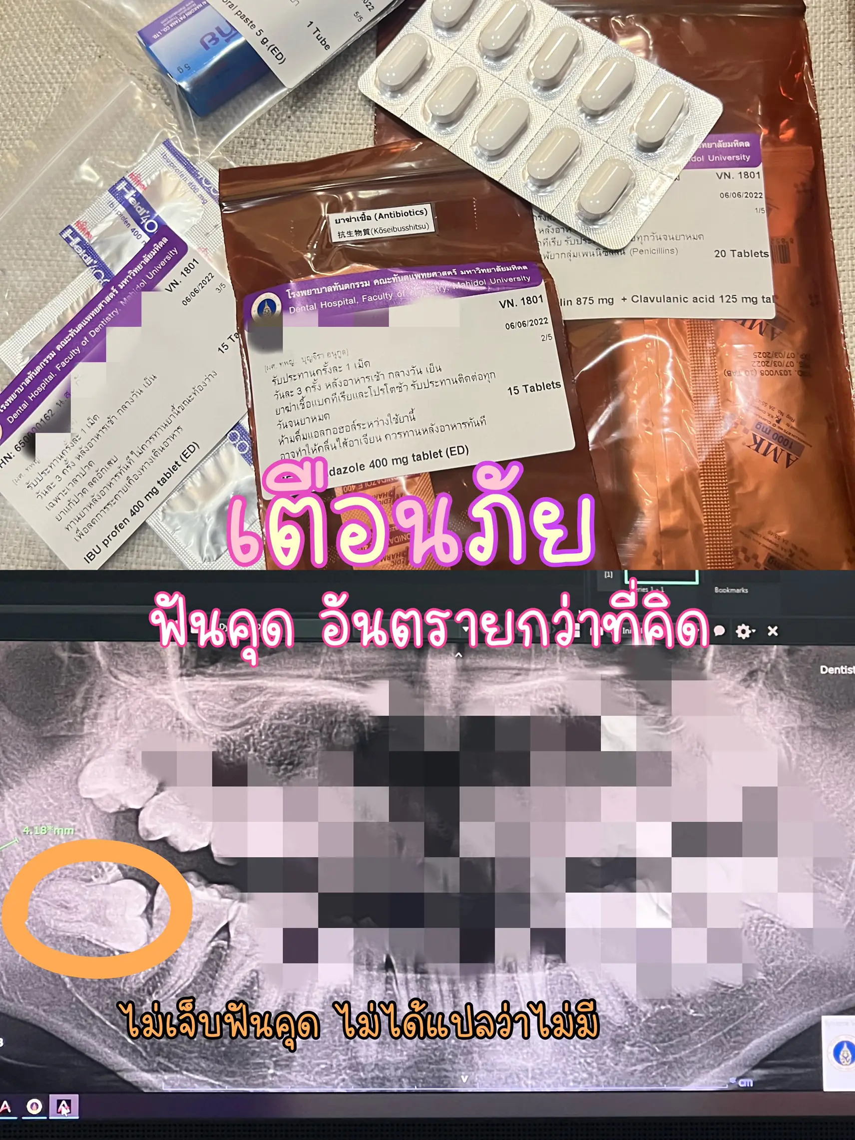 ฟันคุดใกล้เส้นประสาท อันตรายมั้ย 😮 | แกลเลอรีที่โพสต์โดย wsp | Lemon8