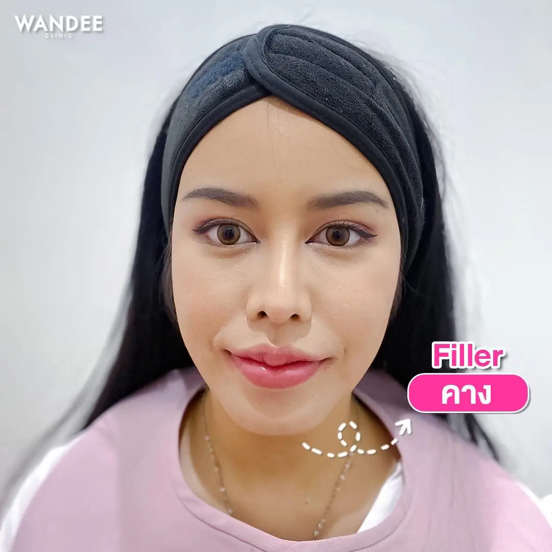 Review : เปลี่ยนคางตัด ให้เป็นคางเรียวสวย🤩 | แกลเลอรีที่โพสต์โดย Wandee Clinic | Lemon8