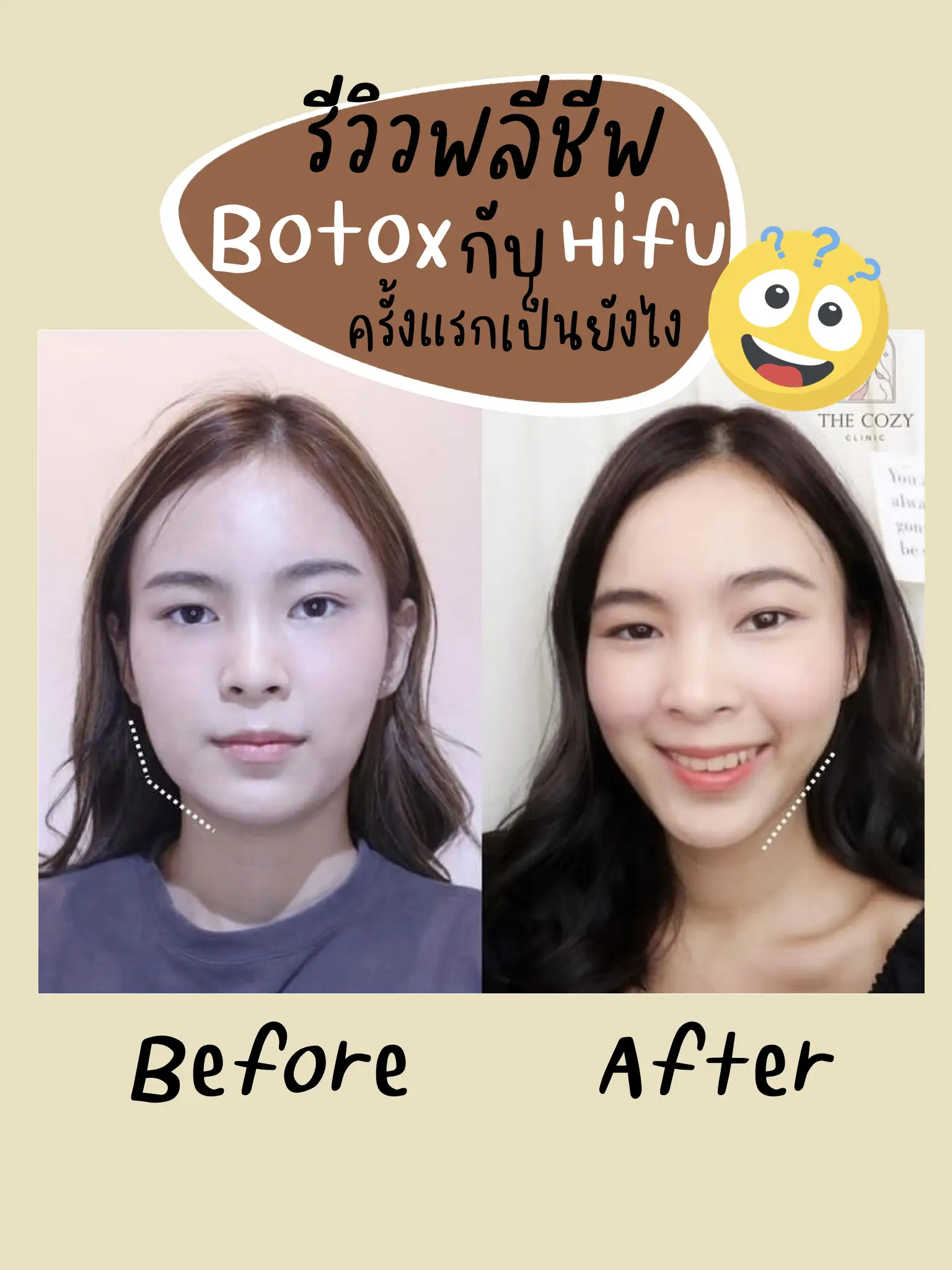 รีวิวเรียลๆ Fat+Botox+Hifu 📍ธรรมดาคลินิก | แกลเลอรีที่โพสต์โดย Chungching🌷 | Lemon8