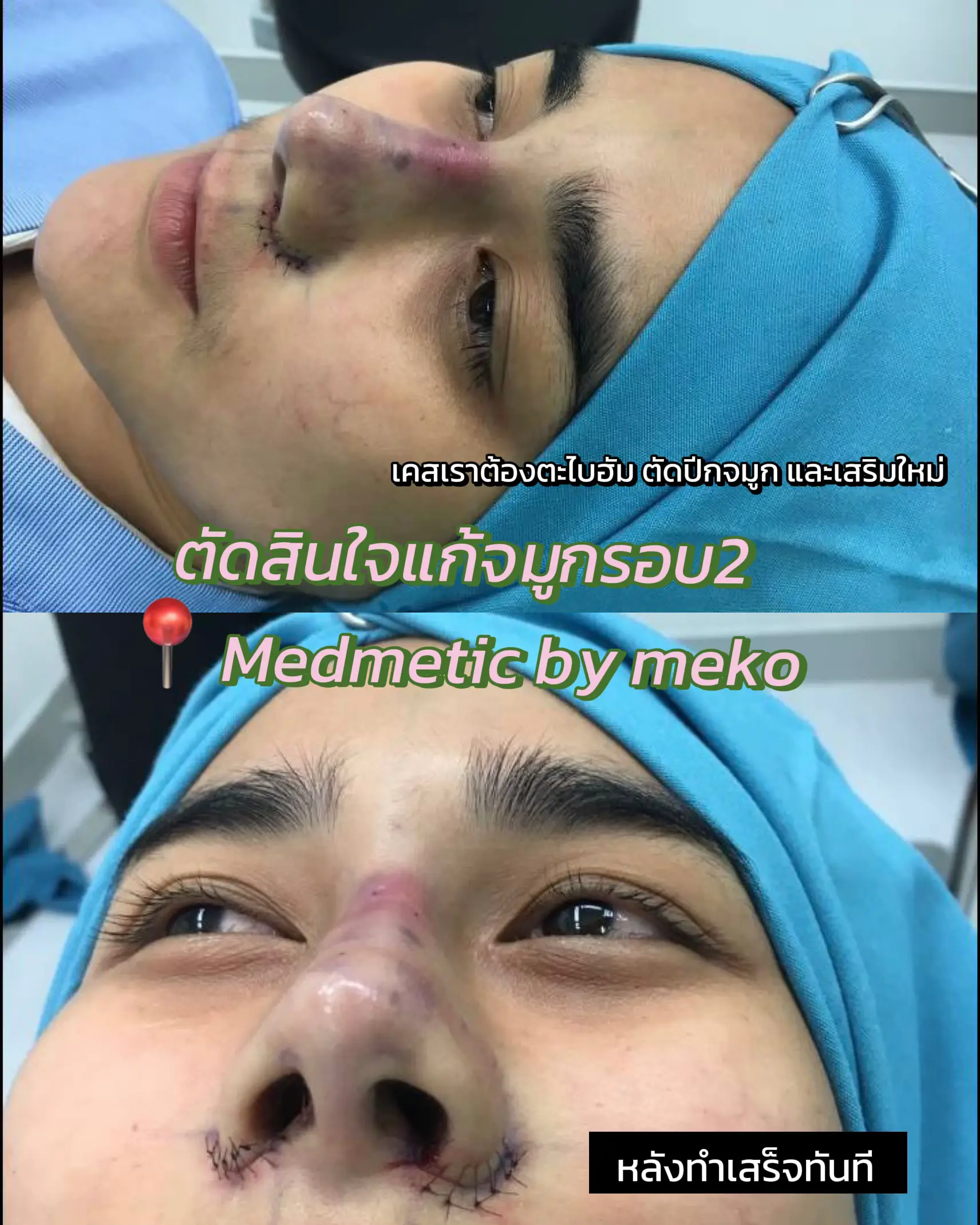 แก้จมูกรอบ2ปังหรือตุบมาดูกัน | แกลเลอรีที่โพสต์โดย Napatch.kat | Lemon8