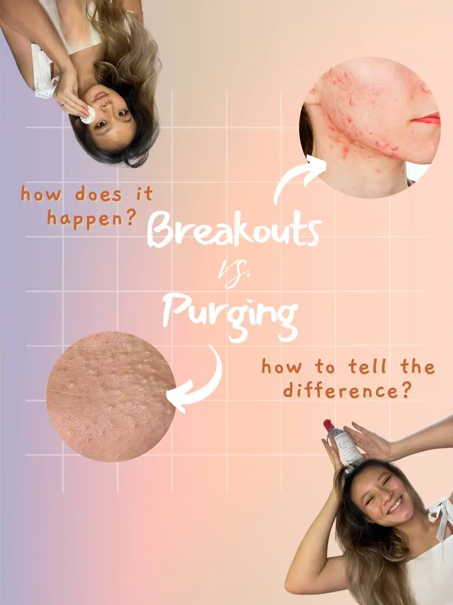 Are you purging or breaking out? Know your skin | Gallery posted by ...