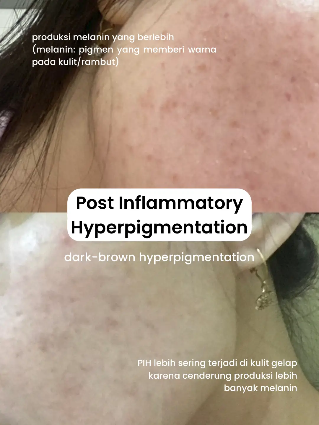 Bekas Jerawat: PIE vs PIH? Apa bedanya?🤔 | Galeri diposting oleh ...