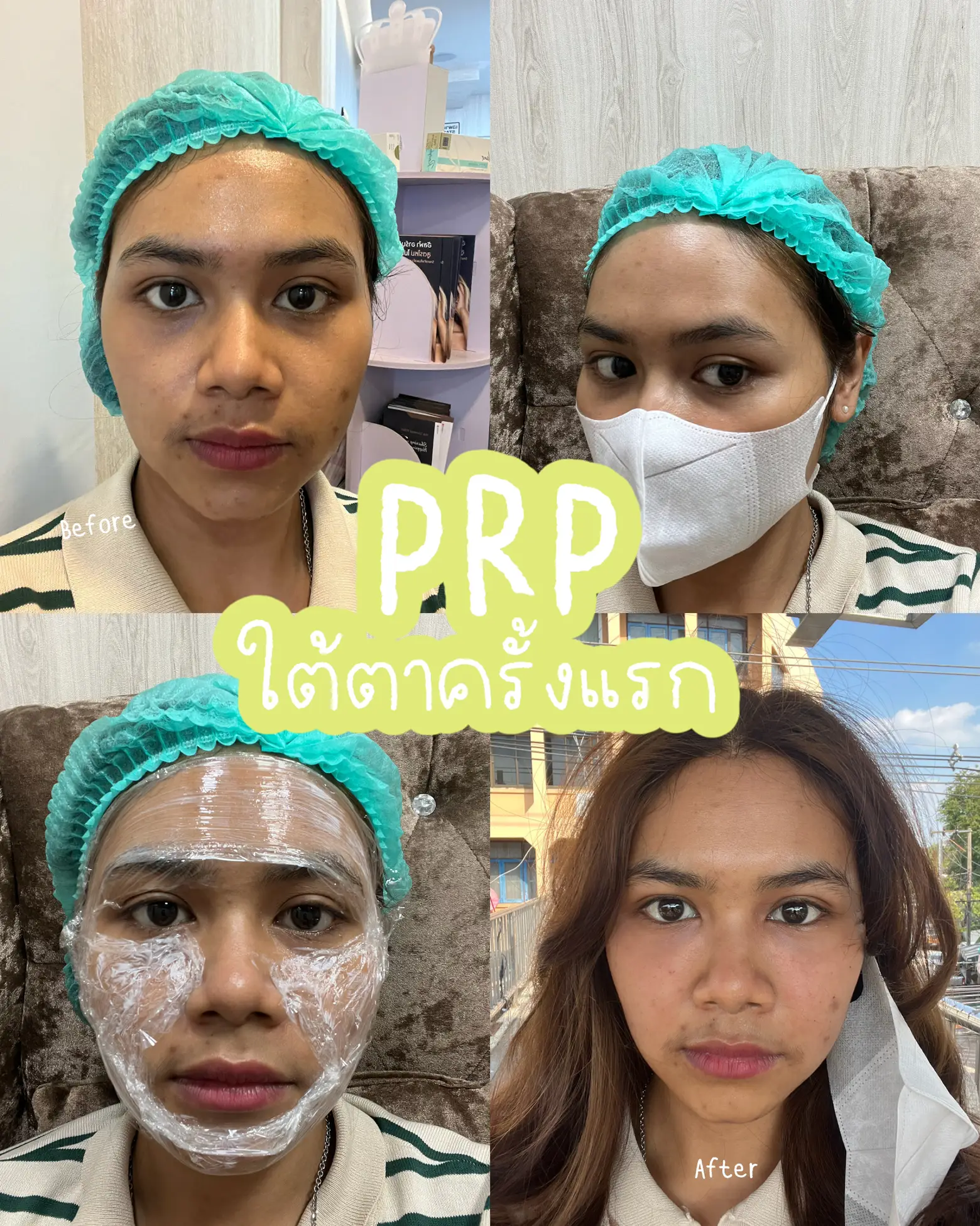 radiant codeฉีด - การค้นหาใน Lemon8