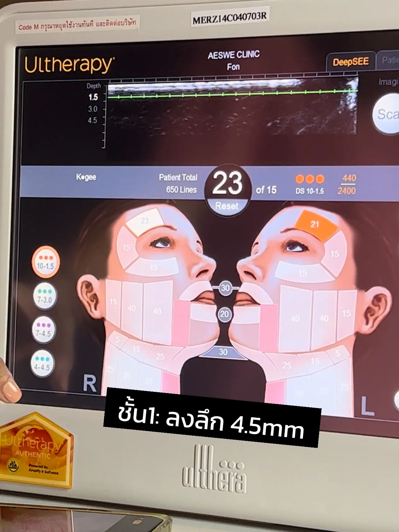 Ulthera เครื่องแท้จากUSA สำหรับสาววัย30+ ผู้ไม่ยอมเหี่ยวย่น | แกลเลอรีที่โพสต์โดย Kiki | Lemon8