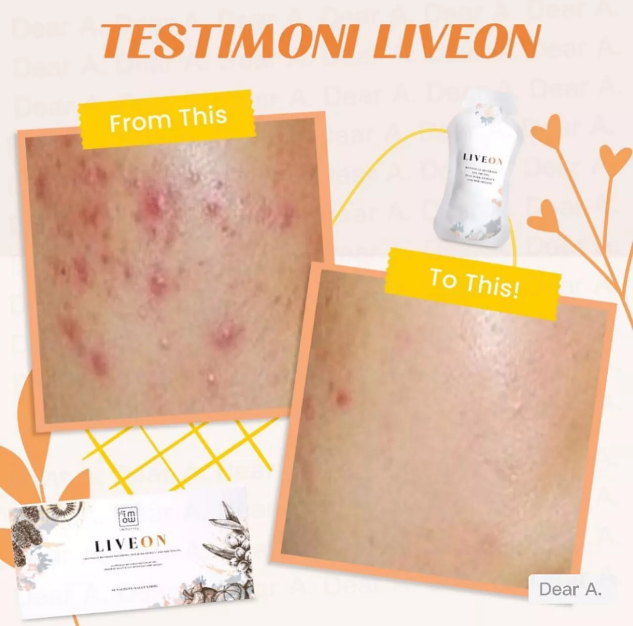 Know why there are pimples on | Galeri disiarkan oleh 1grp_Stella97gu | Lemon8