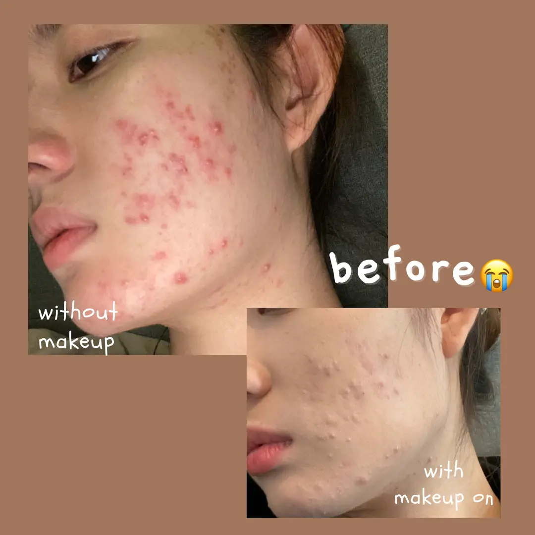 Tretinoin and Hyperpigmentation - การค้นหาใน Lemon8