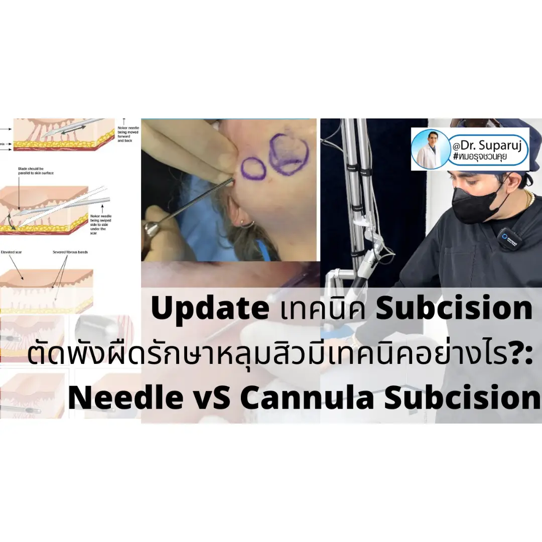 เทคนิค Subcisionตัดพังผืดรักษาหลุมสิว Acne Scar Subcision | แกลเลอรีที่ ...