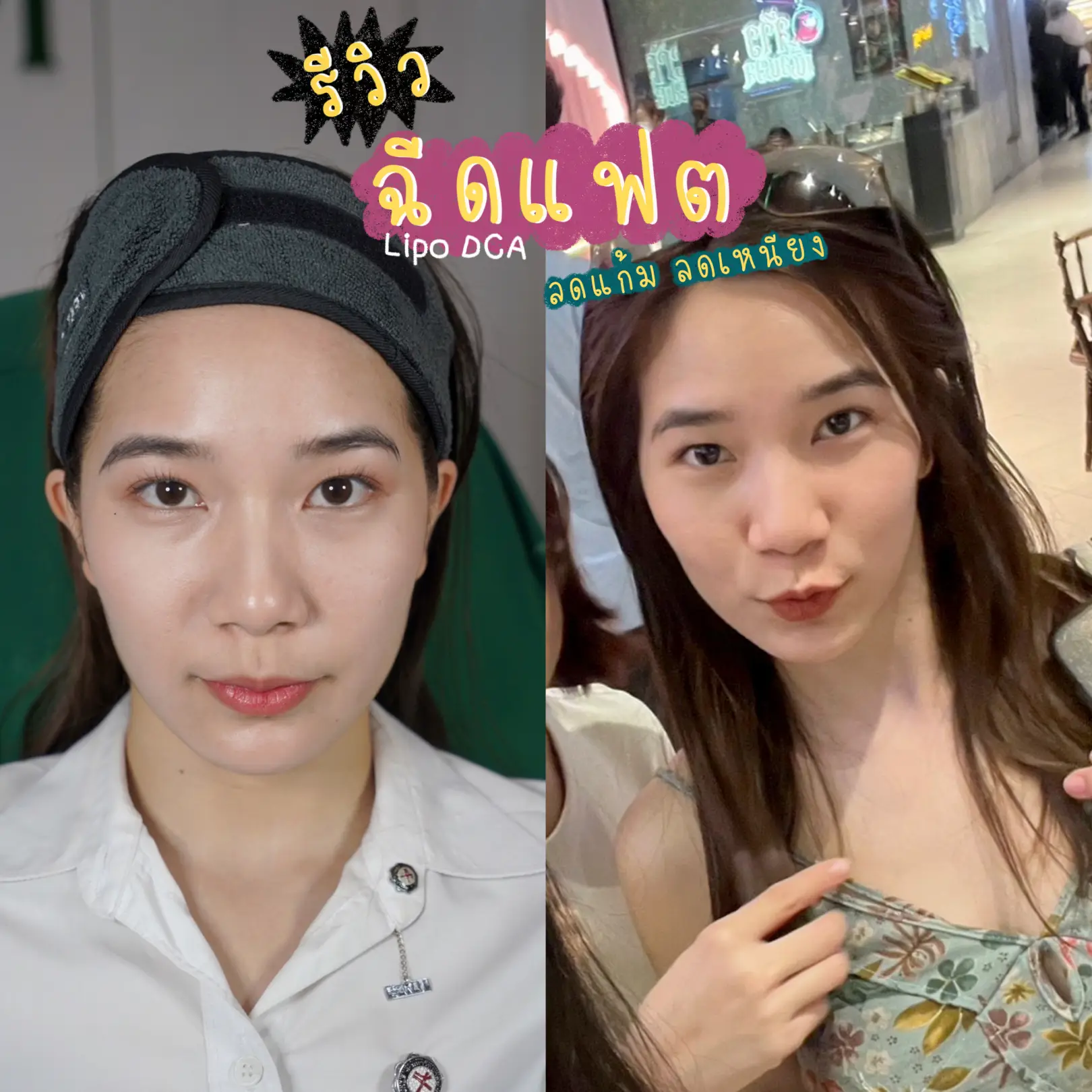 รีวิว ฉีดแฟต Lipo DCA สลายไขมัน หน้าวีสุด💁🏻‍♀️ | แกลเลอรีที่โพสต์โดย Kanomjeannnnnn | Lemon8