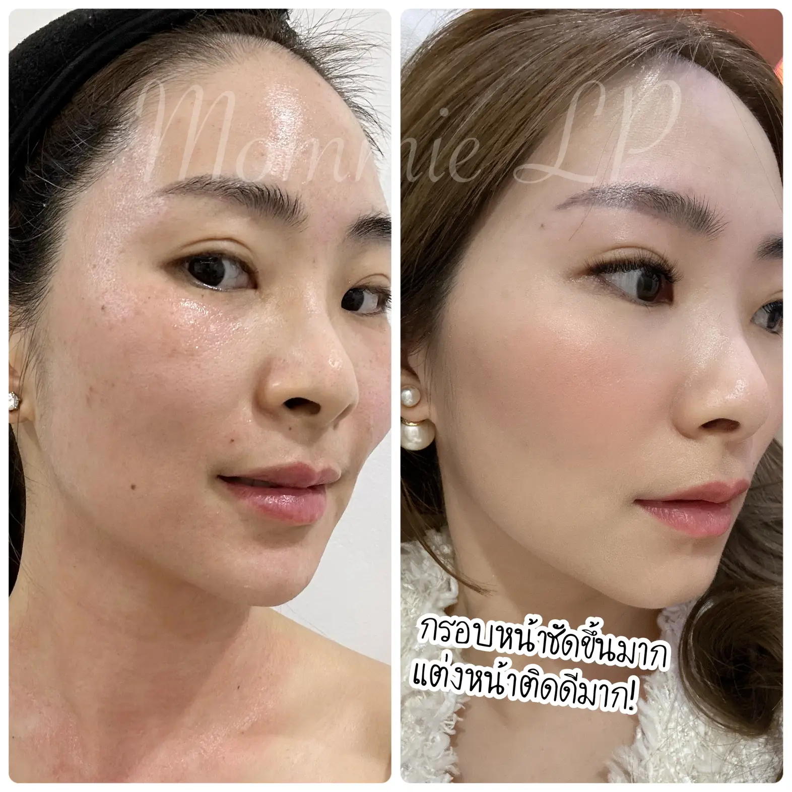 Morpheus8 แบบที่ดาราฮอลีวู้ดเค้าทำกัน! | แกลเลอรีที่โพสต์โดย Mommie LP | Lemon8