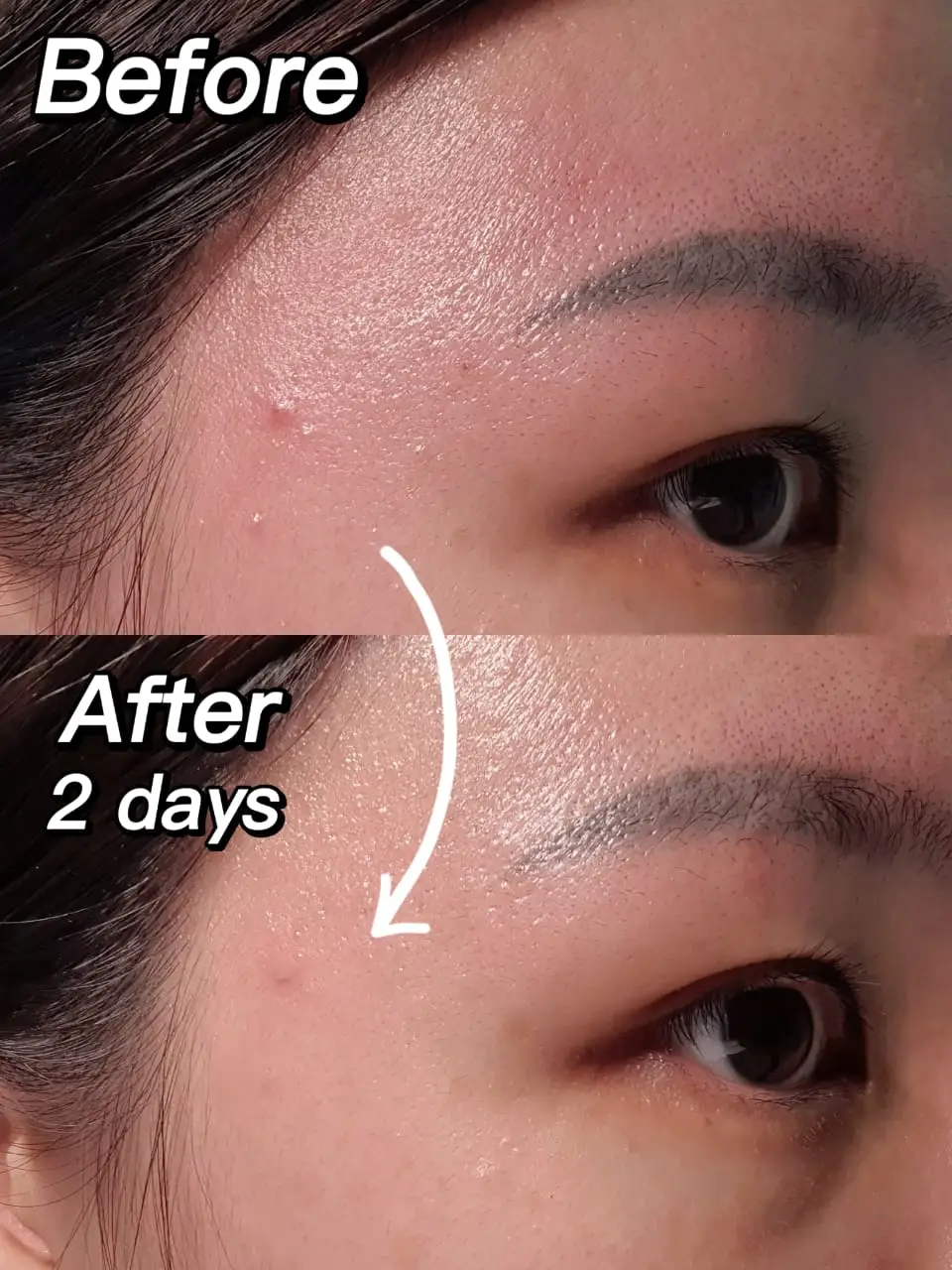 Effective Acne Roller Review‼️ | แกลเลอรีที่โพสต์โดย Carrotlobak | Lemon8