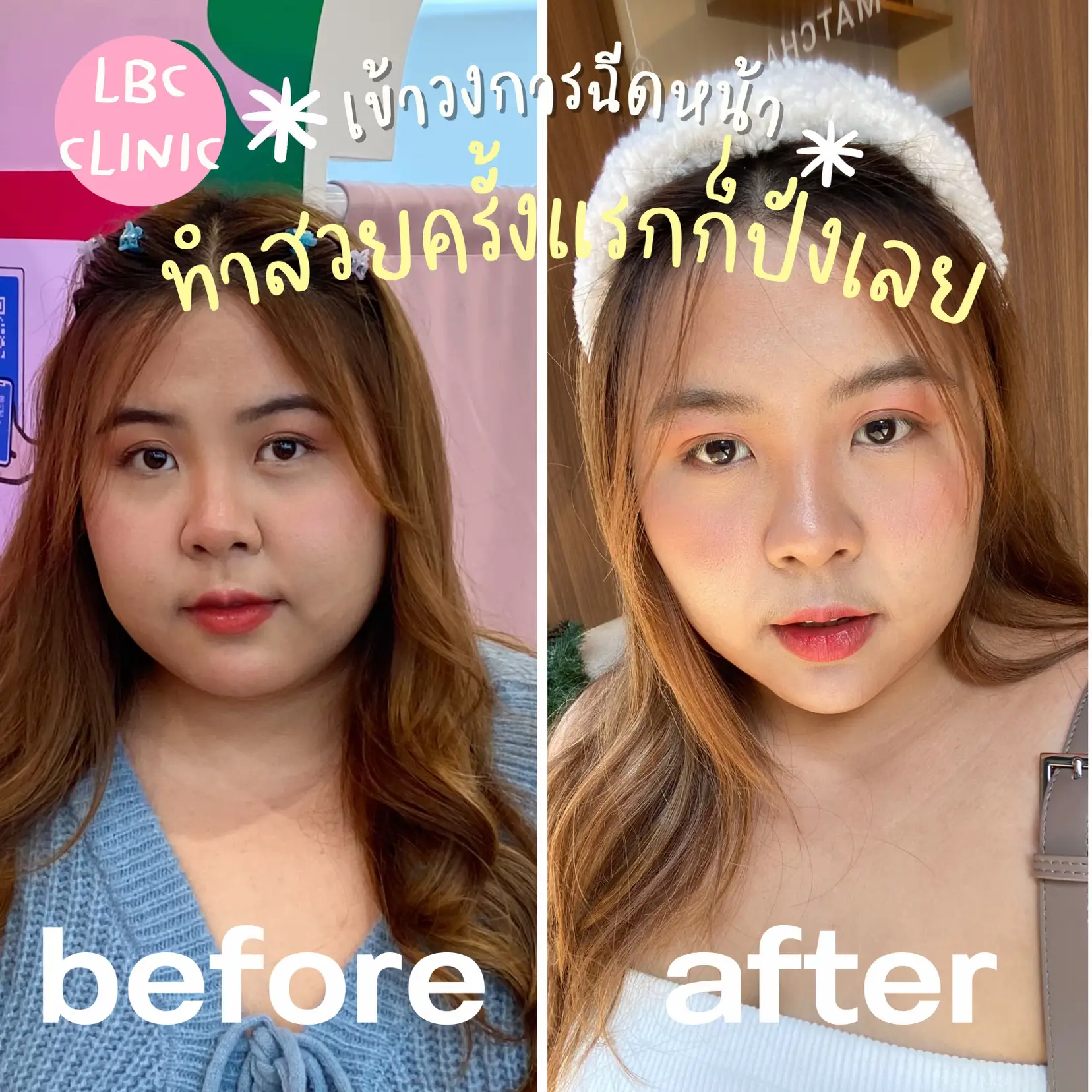 ฉีดแฟตหน้า เหนียง lbc - การค้นหาใน Lemon8
