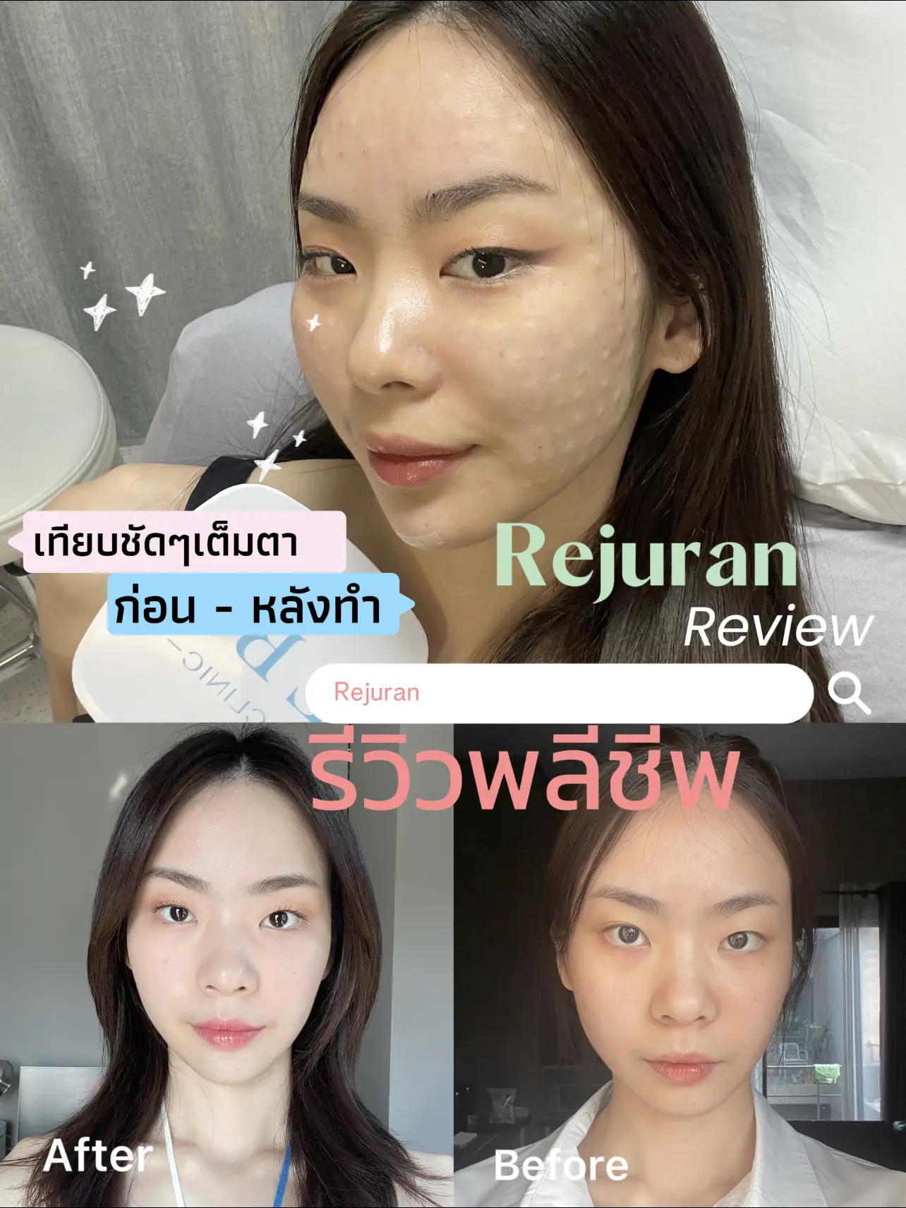 รีวิวพลีชีพ หน้าสดหลังทำ Rejuran ฉ่ำเหมือนกินน้ำวันละ 8 แก้ว🥛 | แกลเลอรีที่โพสต์โดย Kikinicha ...