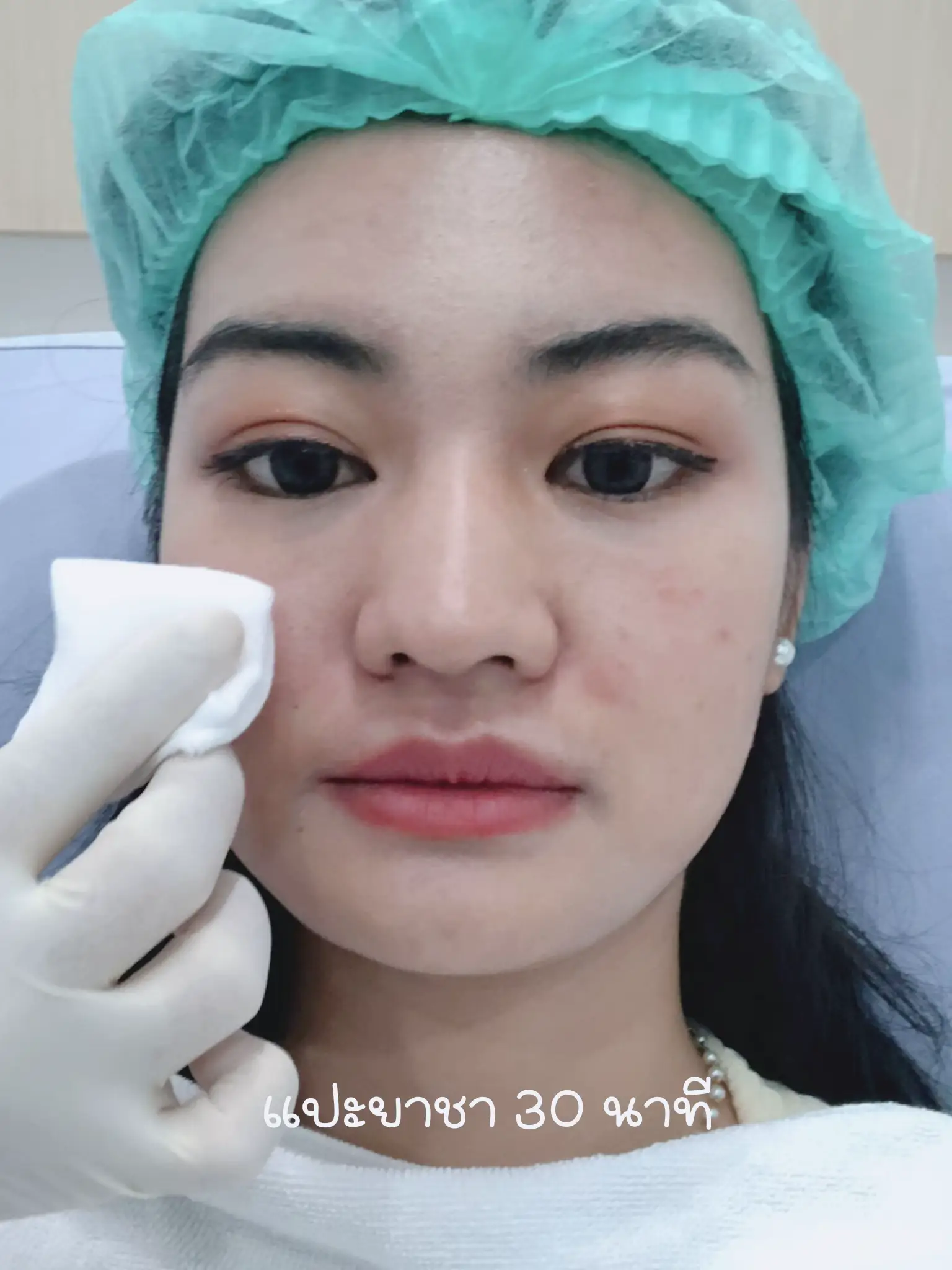 ฉีดfillerร่องแก้ม - การค้นหาใน Lemon8