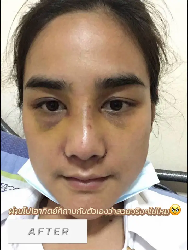 แก้จมูกรอบ2ปังหรือตุบมาดูกัน | แกลเลอรีที่โพสต์โดย Napatch.kat | Lemon8