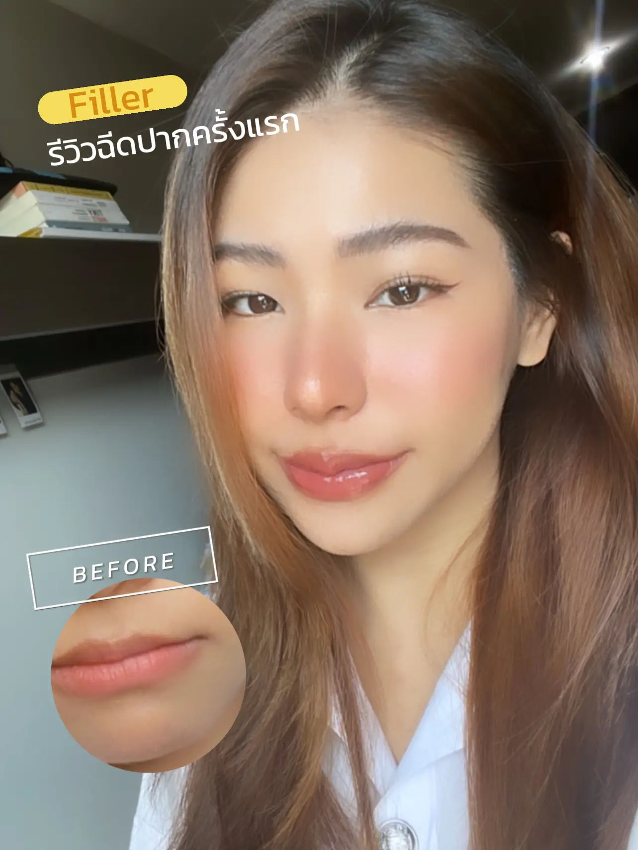 Life-changing mouth Filler injection! | Gallery posted by pepperprek | Lemon8