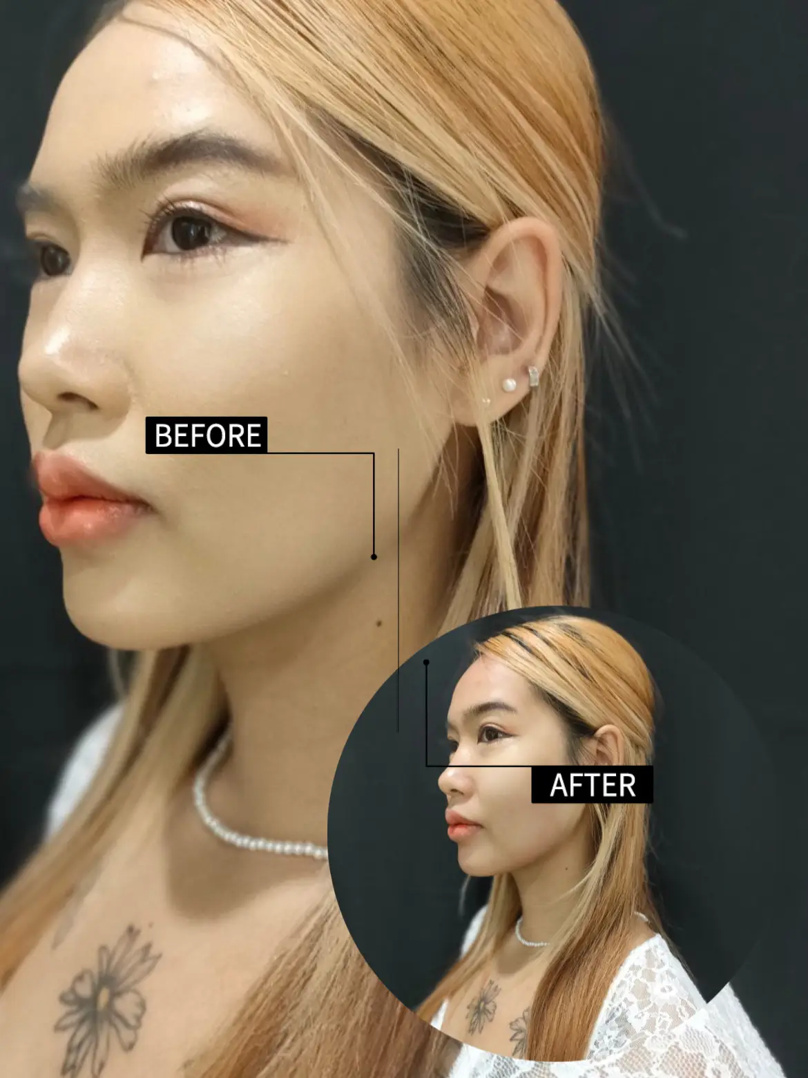 ultarformer iii (the loft clinic by. dr.bright) | แกลเลอรีที่โพสต์โดย Pluto.P | Lemon8