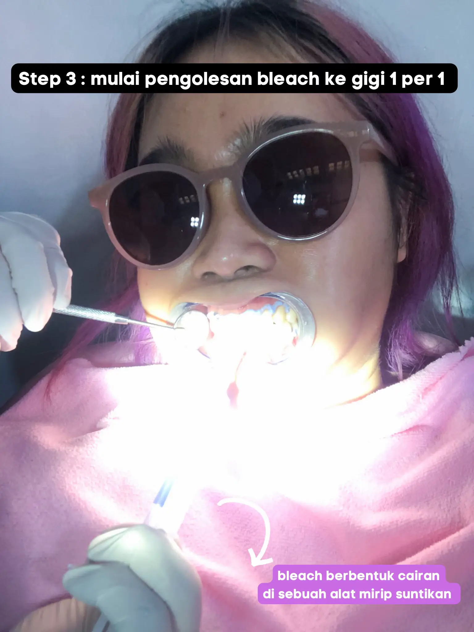 BLEACHING GIGI GRATIS!! | Galeri diposting oleh Yuka | Lemon8