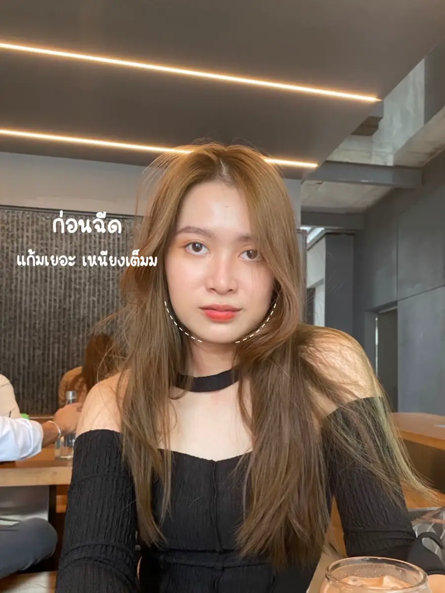 ฉีดแฟตหน้า เหนียง lbc - การค้นหาใน Lemon8