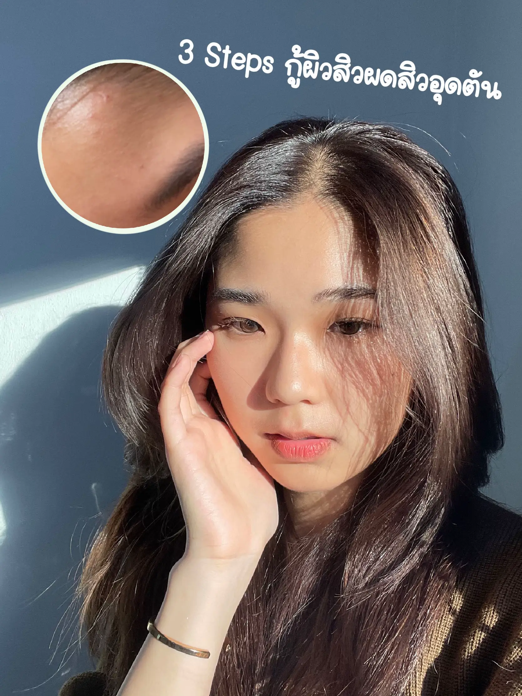 3. Stepลดสิวง่ายๆ ใครๆก็หน้าใสได้ | แกลเลอรีที่โพสต์โดย Jinn.jpt | Lemon8