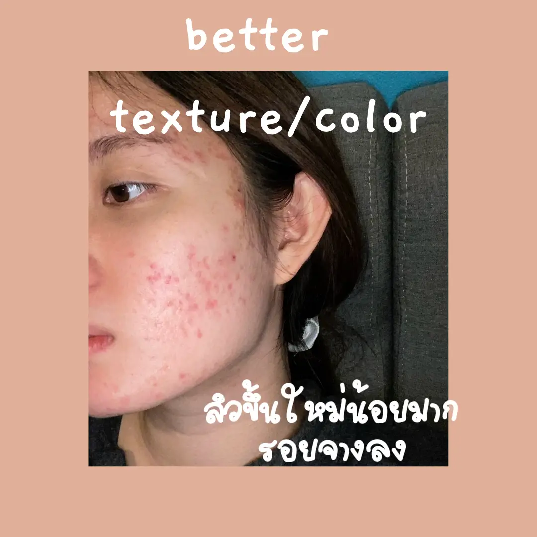 Tretinoin and Hyperpigmentation - การค้นหาใน Lemon8