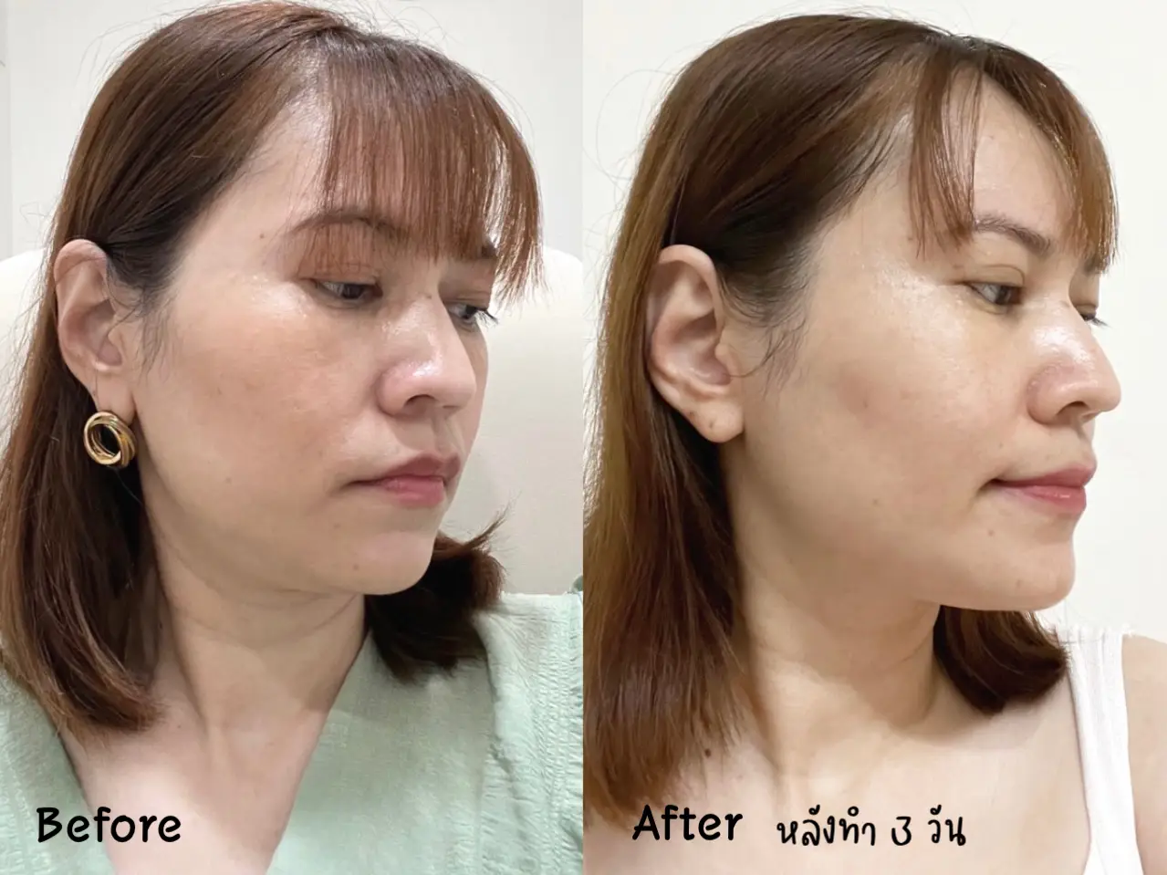 ฉีด sisi meso fat ครั้งแรก ได้ผลมากน้อยแค่ไหน?? | แกลเลอรีที่โพสต์โดย แพ็ทก็ไปเรื่อย | Lemon8