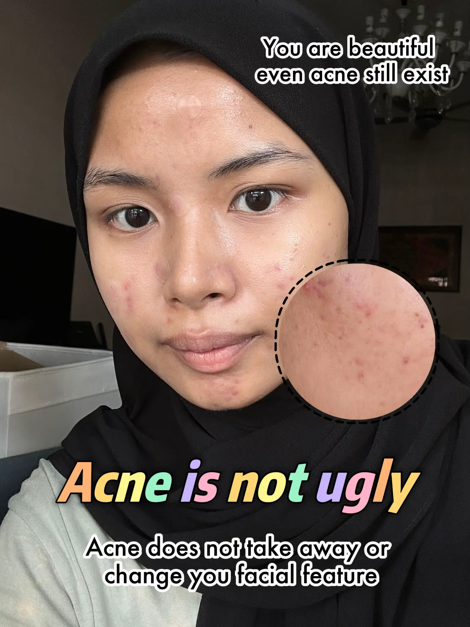 LOVE YOUR ACNE SKIN ️ Self-Love | แกลเลอรีที่โพสต์โดย Fara Juliana | Lemon8