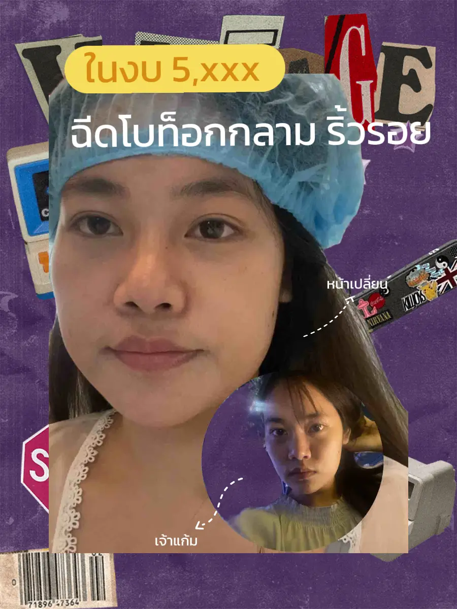 📍ฉีดโบท็อกกราม ริ้วรอย งบ 5 Xxx บาท แกลเลอรีที่โพสต์โดย Noina🩷 Lemon8