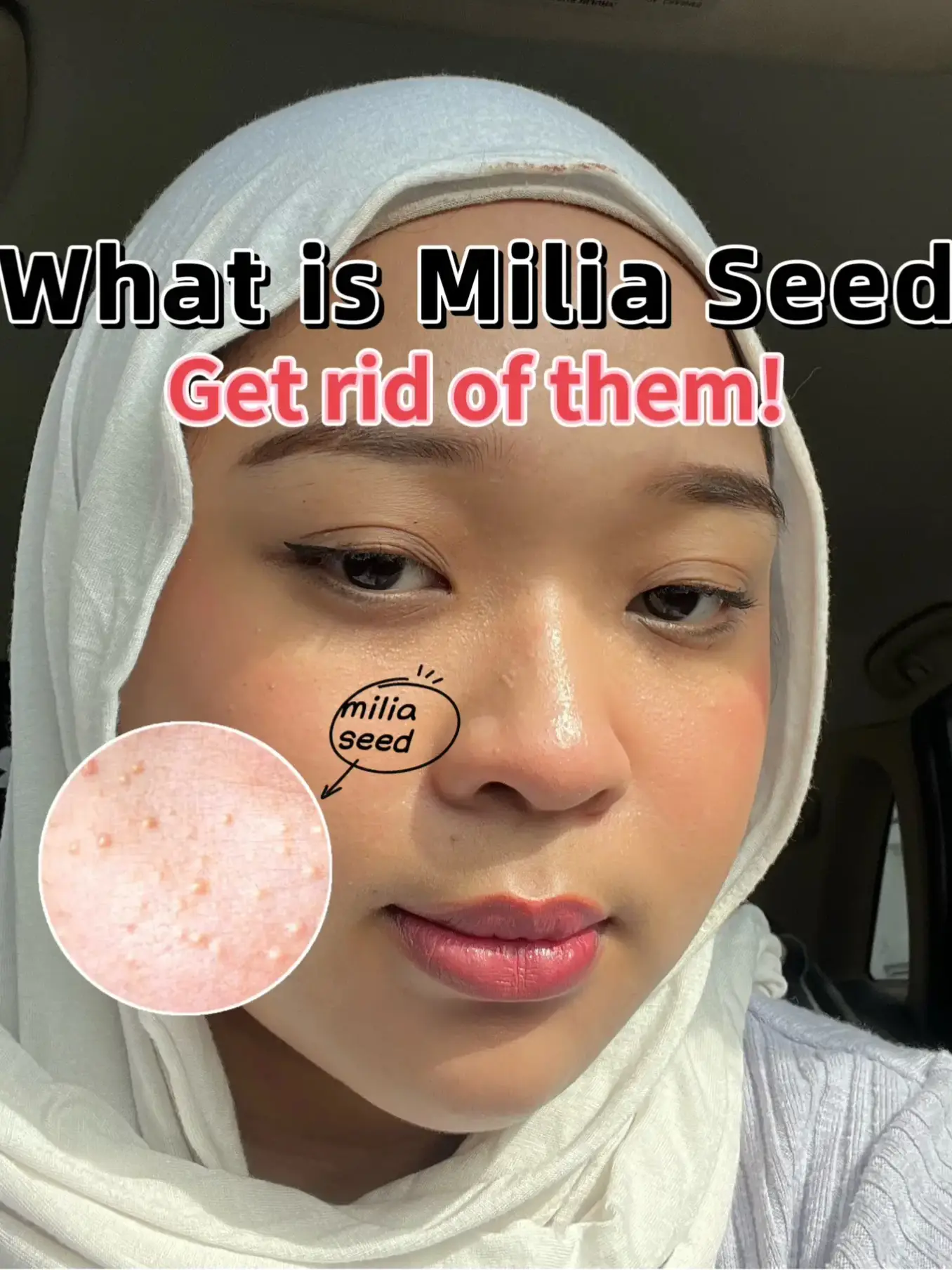 Milia Seed adalah Cysts😖3 ways to get rid of them! | Galeri disiarkan ...