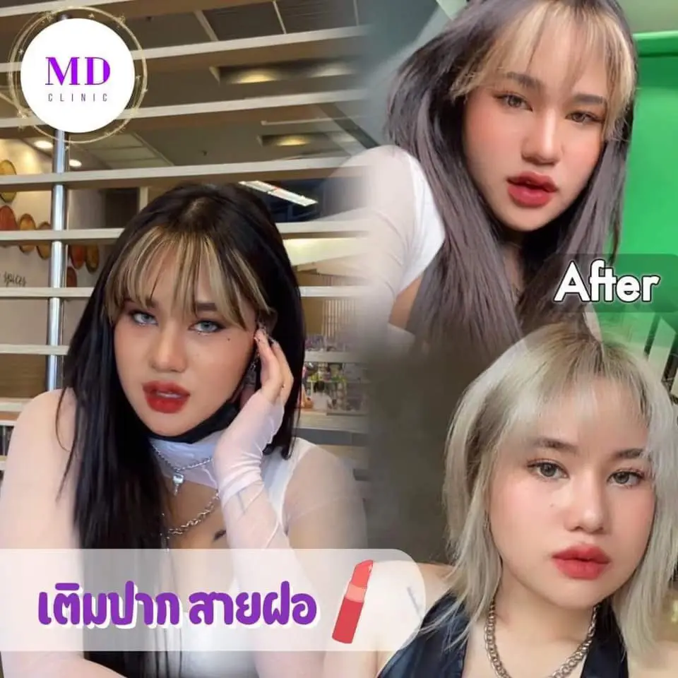 📌🫦รวมทรงปากยอดฮิต 💄💥 | แกลเลอรีที่โพสต์โดย Md clinic | Lemon8