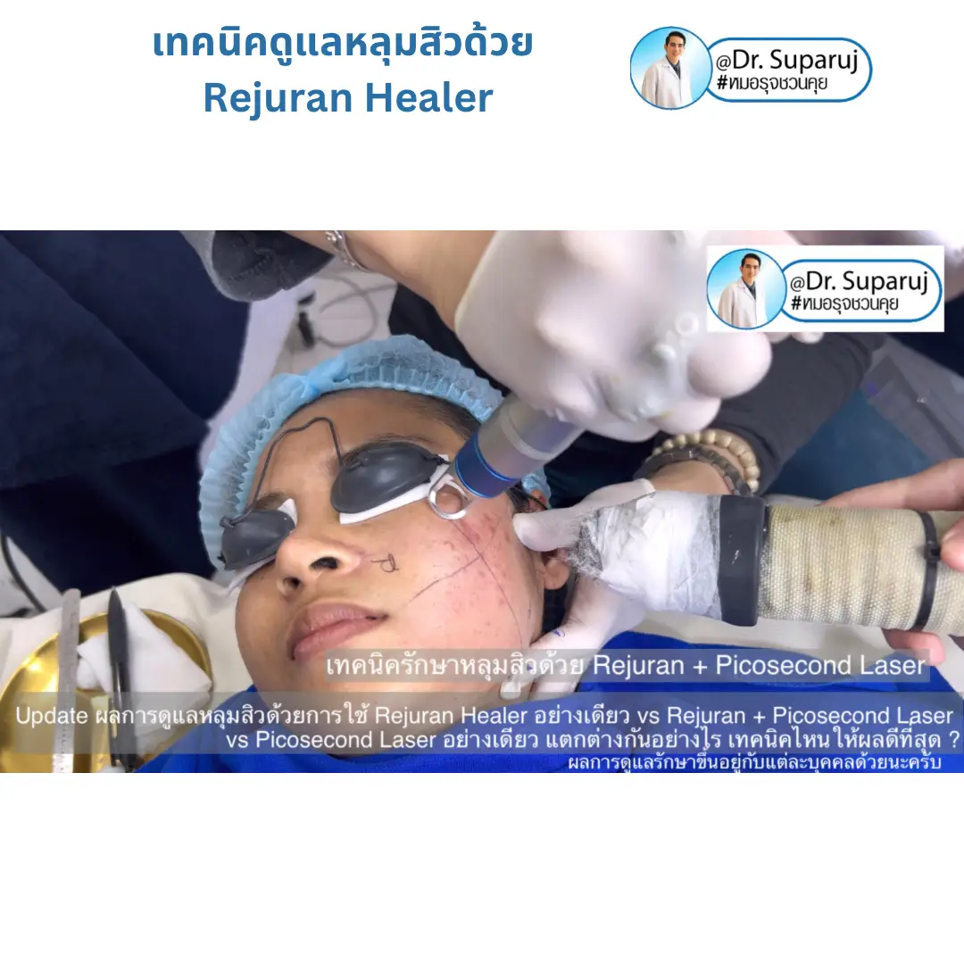 รักษาหลุมสิวด้วย Rejuranอย่างเดียว VS +Picosecond Laser | แกลเลอรีที่โพสต์โดย หมอรุจชวนคุยRuj ...