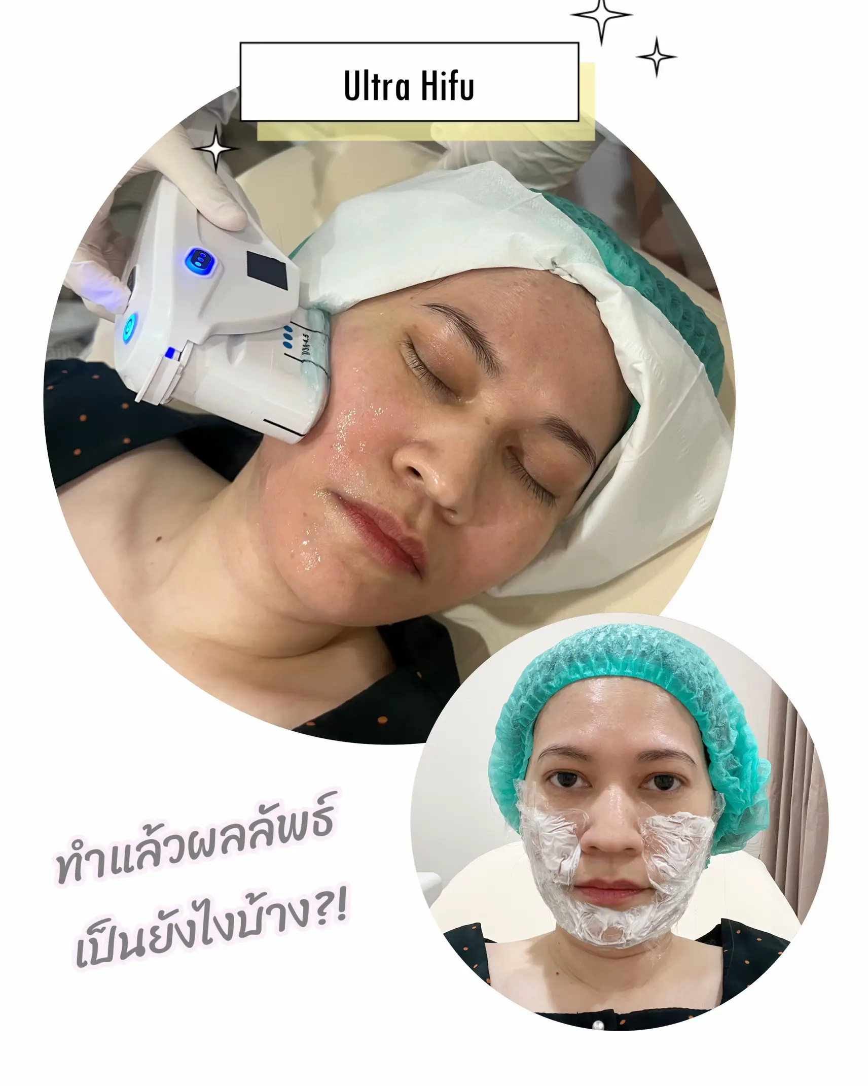 รีวิว ultramax hifu - การค้นหาใน Lemon8