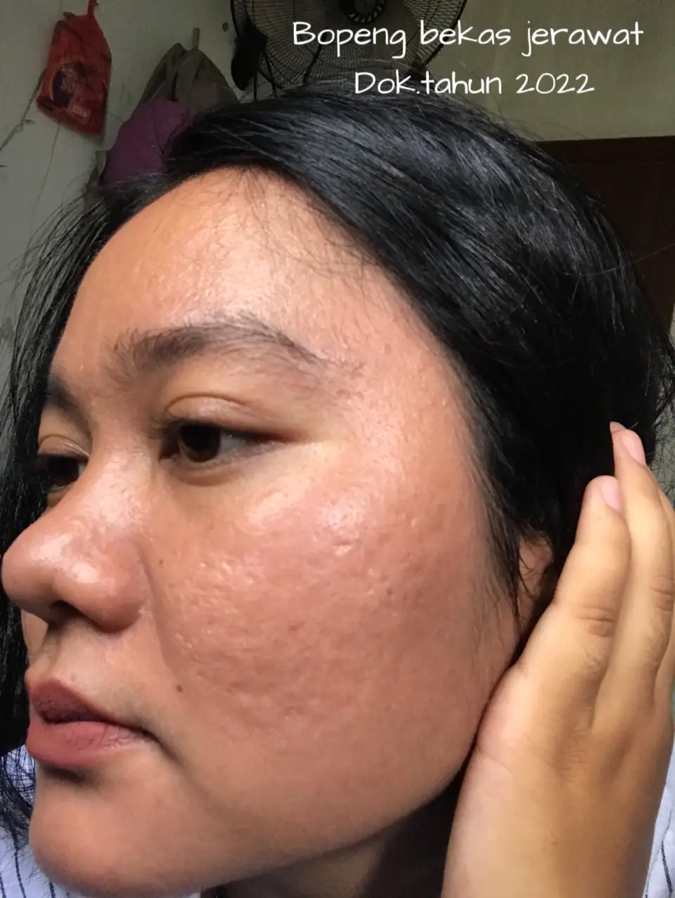 Solusi Kulit Bopeng - Pencarian Lemon8